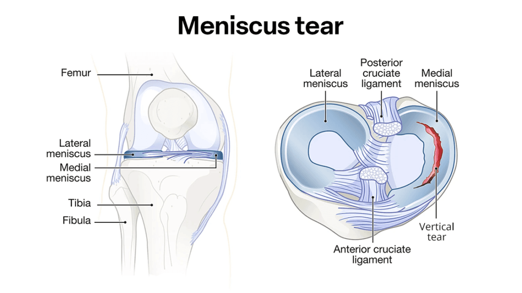 Is Laser Therapy the Meniscus Miracle? | Rheinlaser ️