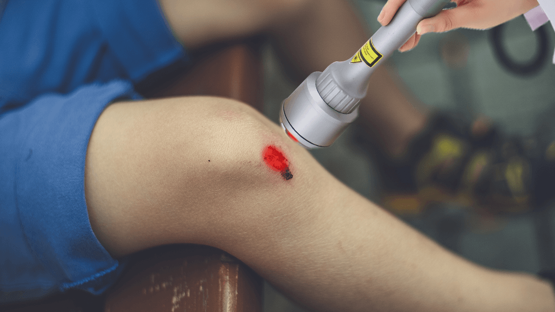 The Science of Laser Therapy for All Wound Types | Rheinlaser ️